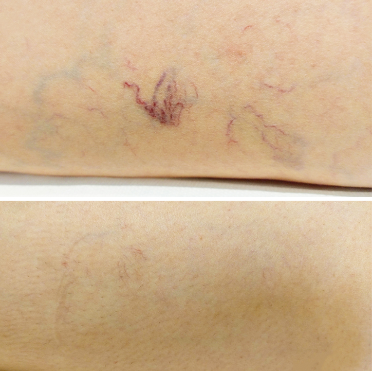 Tratamentul leziunilor cutanate vasculare cu laserul vascular Nd:YAG ...